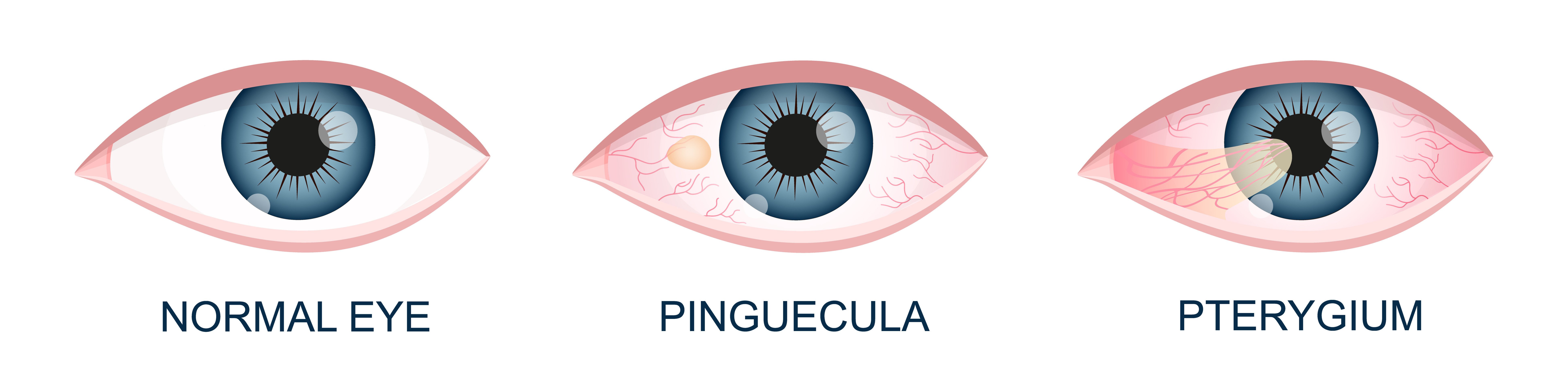 What is a Pinguecula? What is a Pterygium?